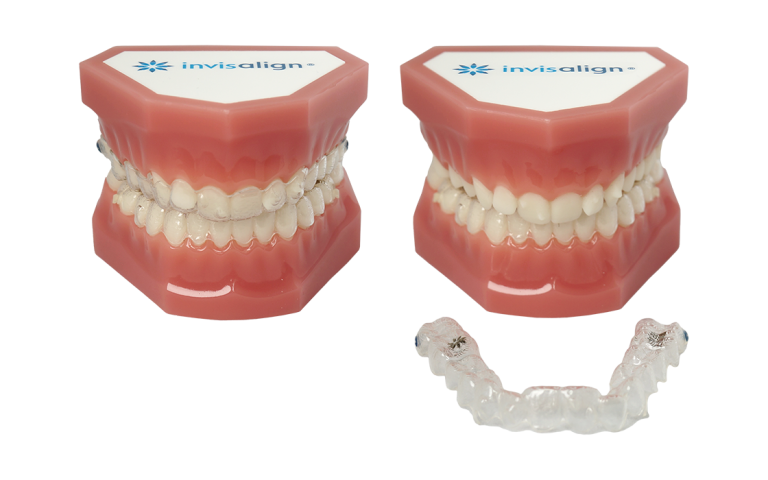Invisalign – Orthodontistenpraktijk Horst